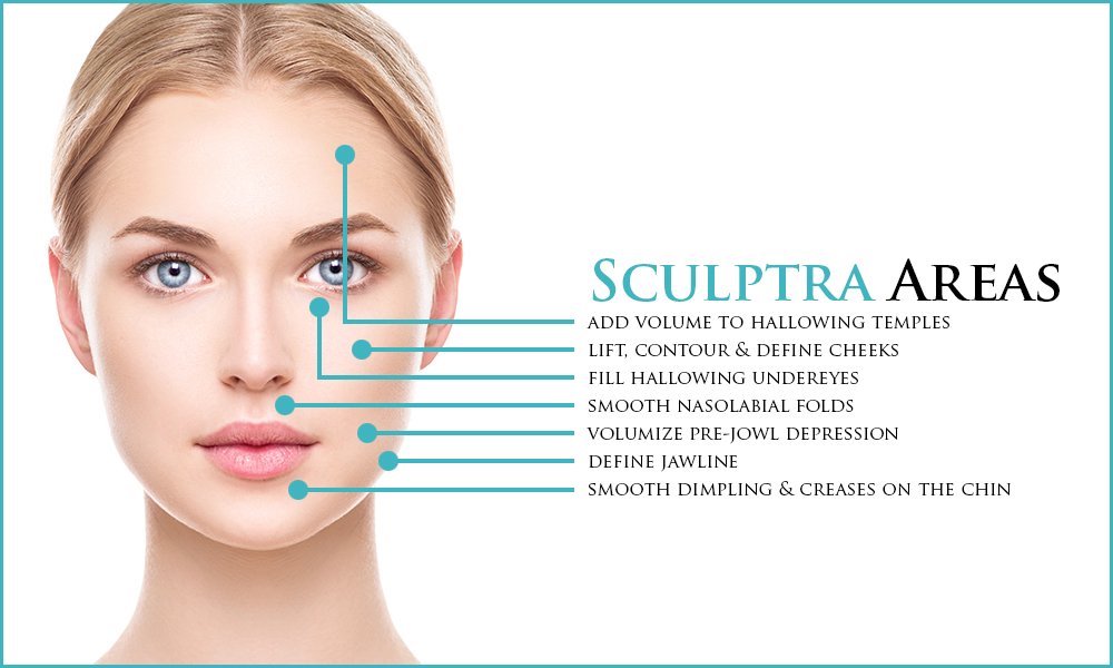 Sculptra – MarSha