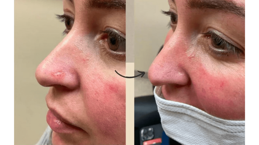 Scar Removal – MarSha
